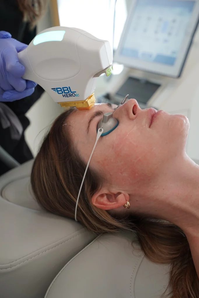 BBL HEROic in Bradenton, FL | Advanced Skin Rejuvenation